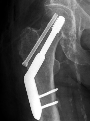 Fixation | The Bone School